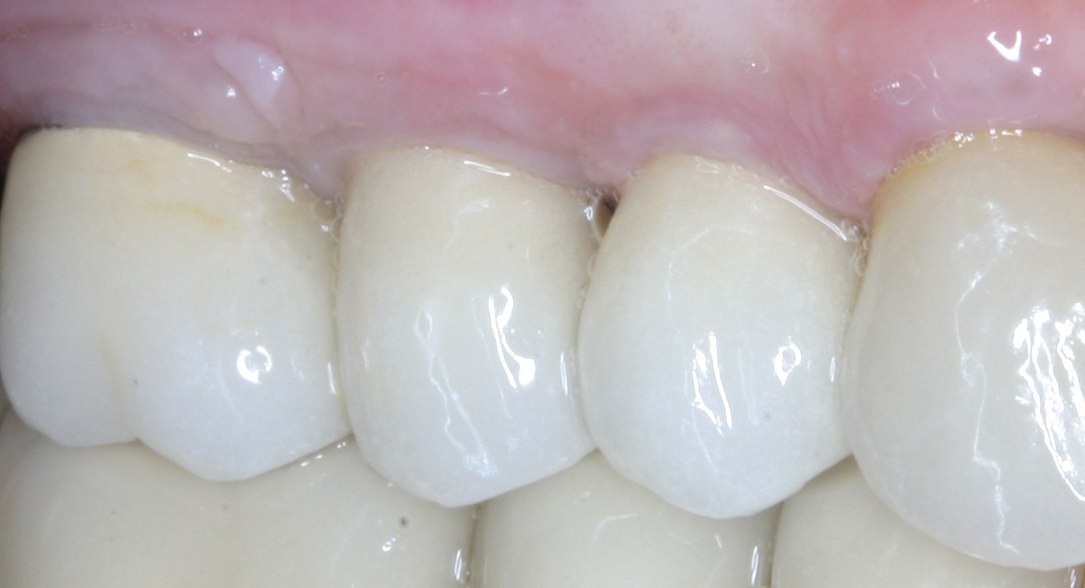 Sinus Augmentation - Dr Steve Wallace